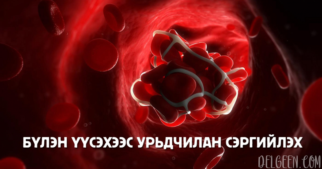 Эрүүл мэндэд ноцтой аюултай цусны бүлэн үүсэхээс хэрхэн сэргийлэх вэ