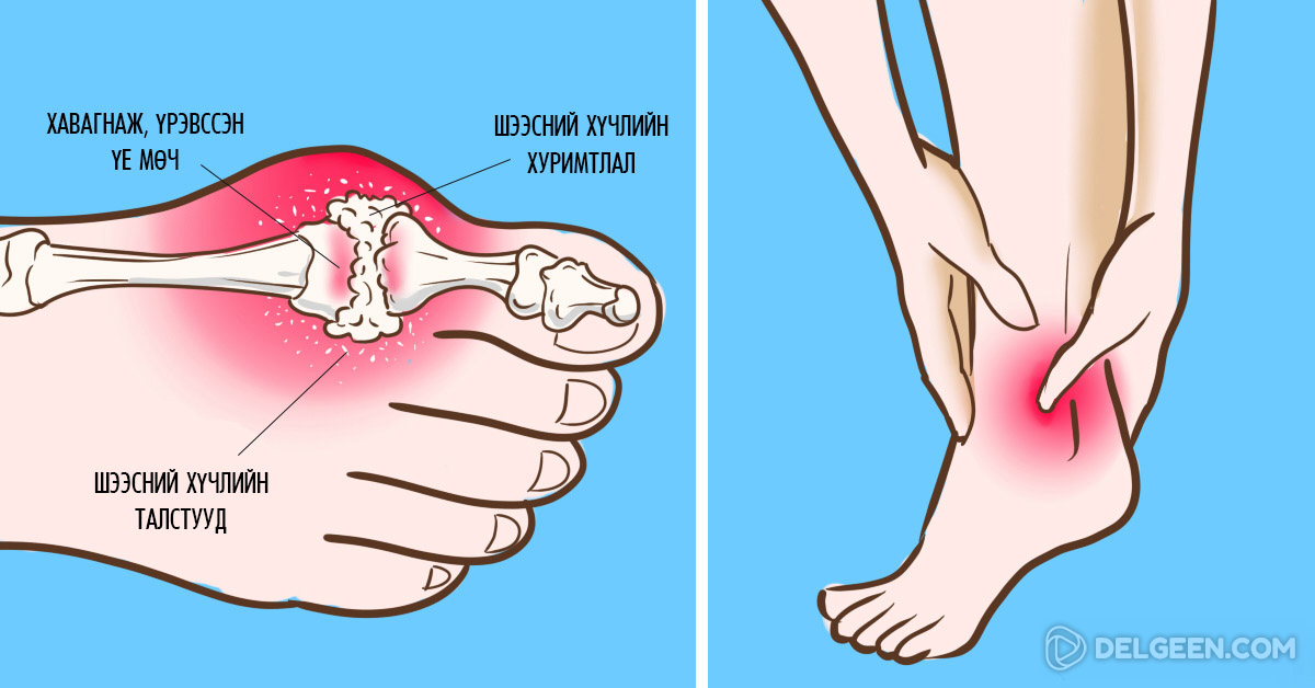 Үе мөчний үрэвсэл артрит зэрэг аюултай өвчнүүдээс нэн даруй ангижрахыг